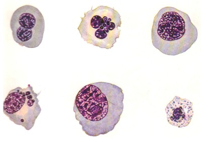 Megaloblasto - Diccionario Médico